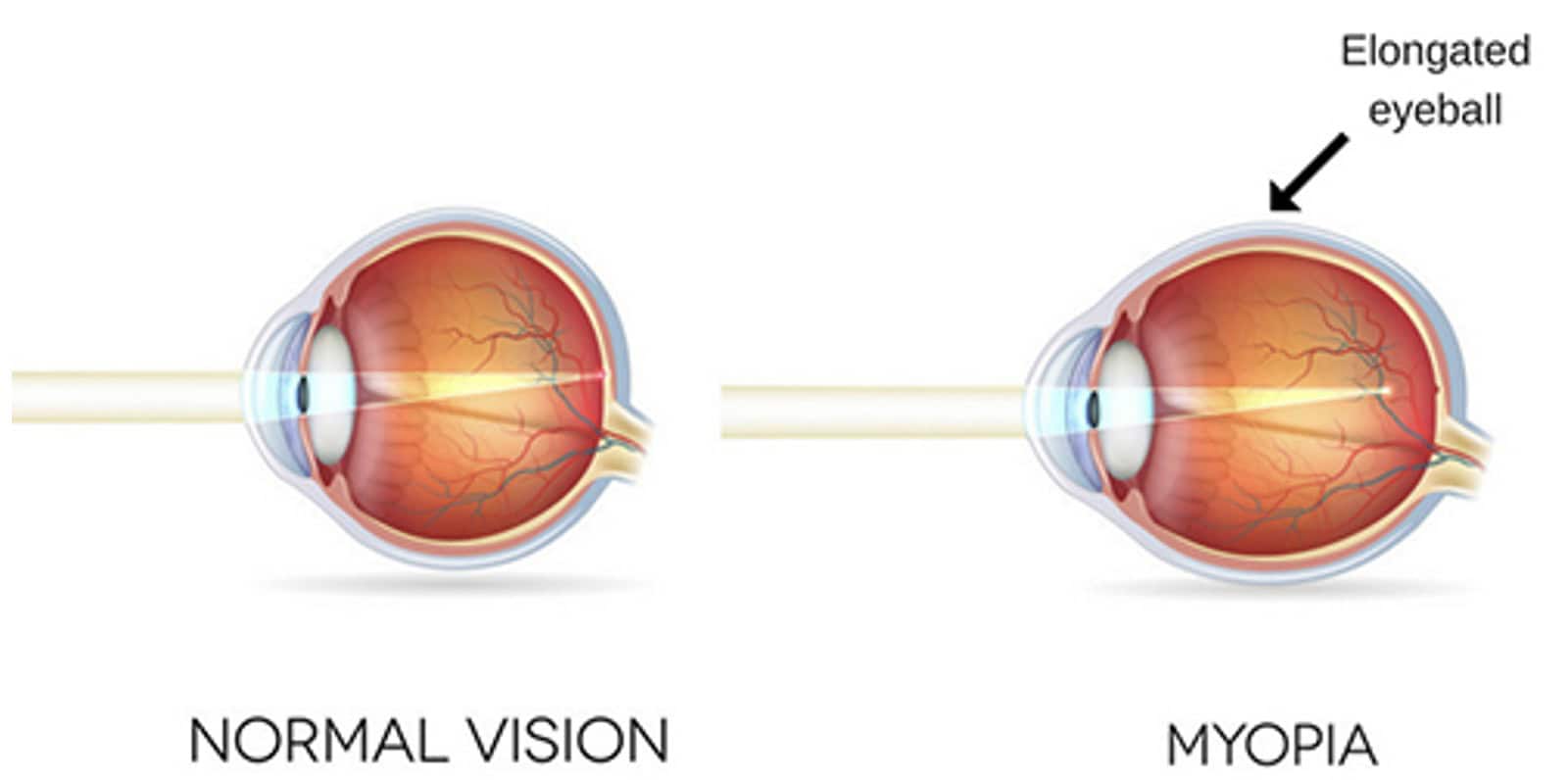 Myopia Management | Expert Care | Vision One 2 One